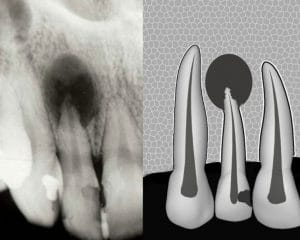 ¿Qué son los quistes en la boca? | CEID Clínica Dental